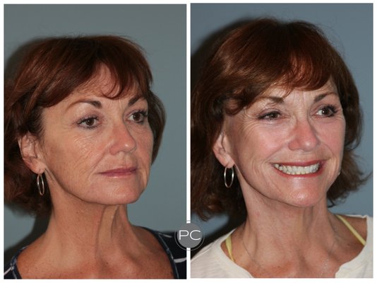 PACIFIC CENTER FOR PLASTIC SURGERY - 95 Photos & 108 Reviews - 3991 ...