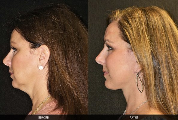 LADNER FACIAL PLASTIC SURGERY - Updated May 2026 - 80 Photos & 70 ...