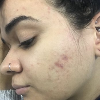 ACNE CLINIC NYC - Updated August 2025 - 99 Photos & 58 Reviews - 501 ...