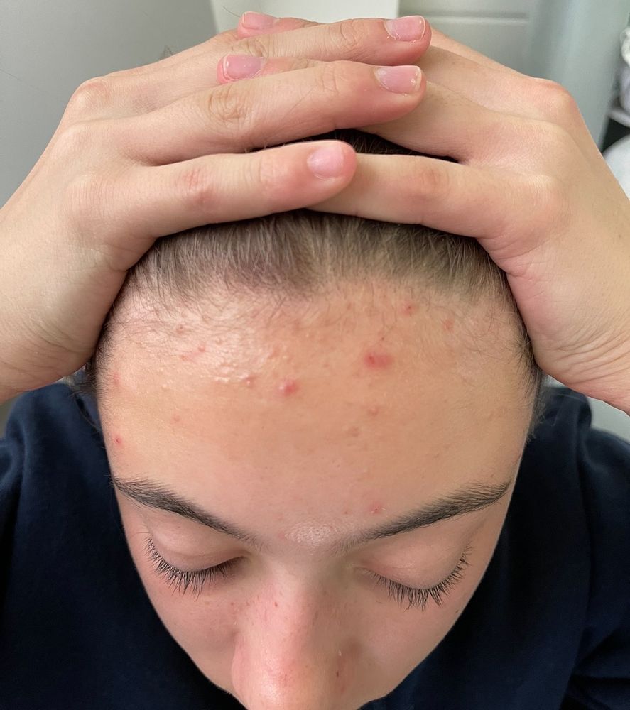 PRODERMA ACNE SYSTEMS FOR TEENS - Updated July 2025 - 9891 Irvine ...