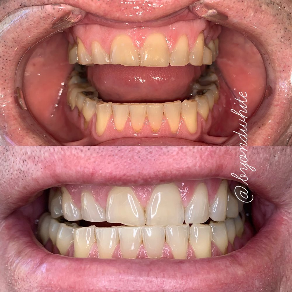 B’YOND WHITE COSMETIC TEETH WHITENING - Updated January 2025 - Request ...