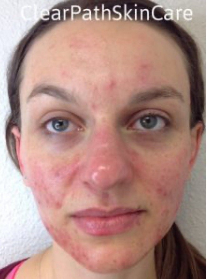 CLEAR PATH ACNE CLINIC AUSTIN NORTH - Updated July 2025 - Request an ...