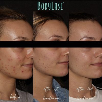 BODYLASE RALEIGH - Updated December 2025 - 191 Photos & 68 Reviews ...