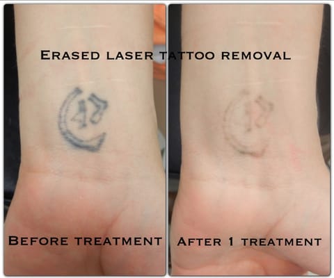 ERASED LASER TATTOO REMOVAL - Updated April 2026 - 71 Photos & 85 ...