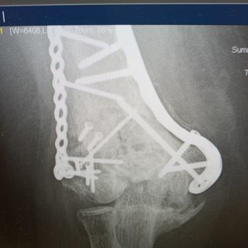 DYNASPLINT SYSTEMS - Updated June 2024 - 11 Photos & 53 Reviews - 770 ...