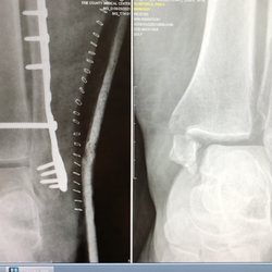 UBMD ORTHOPAEDICS & SPORTS MEDICINE - 30 Photos & 25 Reviews - 4949 ...
