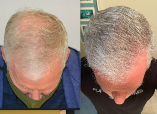ADVANCED HAIR RESTORATION - 28 Photos & 26 Reviews - 11040 Main St ...