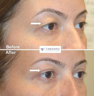 MEHRYAR RAY TABAN MD - OCULOPLASTIC SURGEON - Updated December 2025 ...