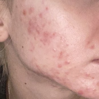 ACNE CLINIC NYC - Updated September 2025 - 99 Photos & 57 Reviews - 501 ...