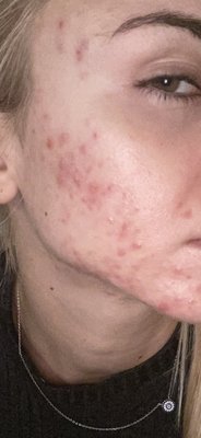 ACNE CLINIC NYC - Updated September 2024 - 106 Photos & 58 Reviews ...