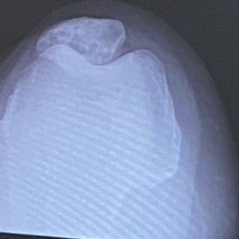 MICHAEL VERCILLO, MD - Updated December 2025 - 58 Reviews - 375 Rolling ...