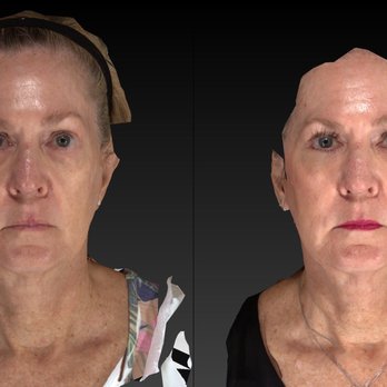 TIMOTHY R. MILLER, MD: REFRESHED AESTHETIC SURGERY - Updated July 2025 ...