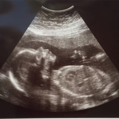 FETAL MEMORIES 2D 3D 4D ULTRASOUND - Updated December 2025 - 151 Photos ...