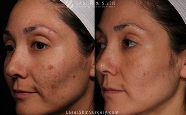 LASER & SKIN SURGERY CENTER OF NEW YORK - Updated December 2025 - 156 ...