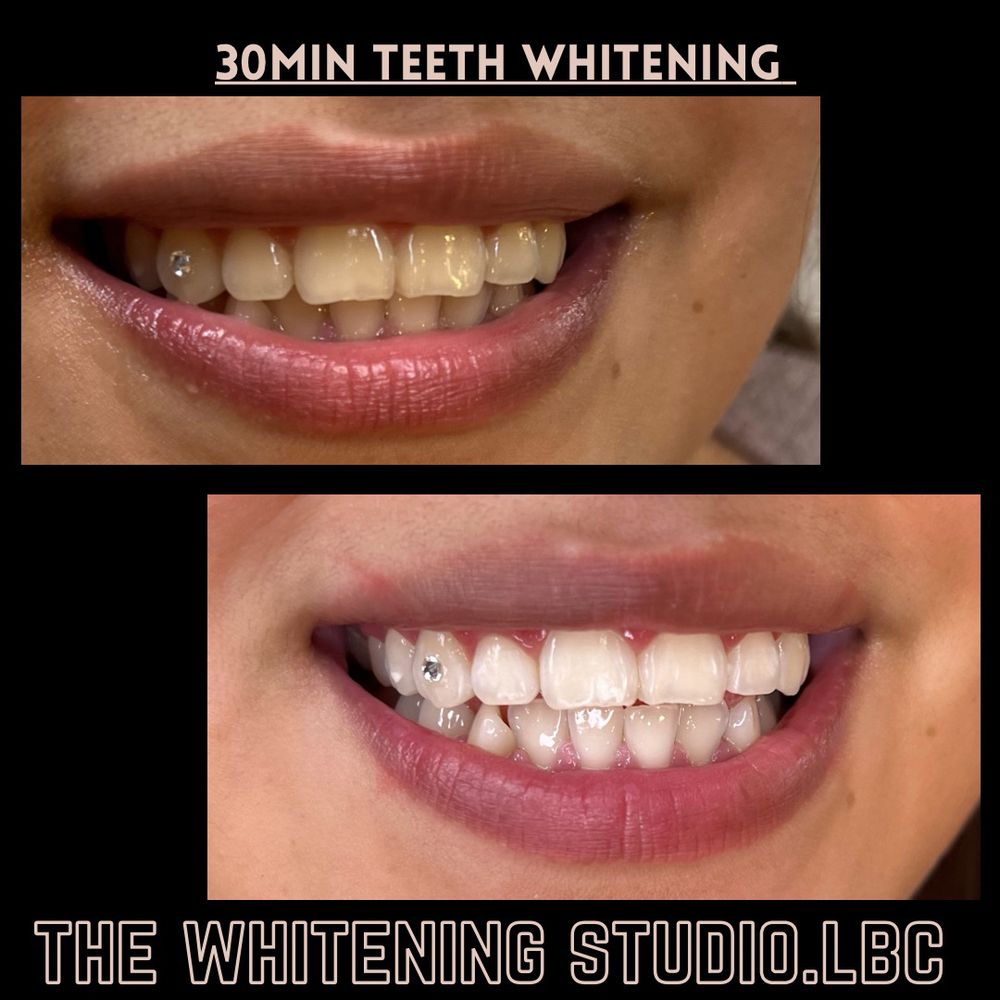 THE WHITENING STUDIO - 14 Photos - Long Beach, California - Teeth ...