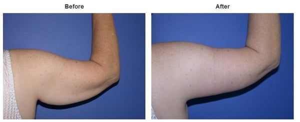 Suzanne Quardt Md Palm Desert Plastic Surgery Updated March 2025