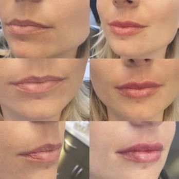 BOTOX SISTERS- LAURA HERTZOG, NP & REBECCA CEVERHA, NP - Updated ...