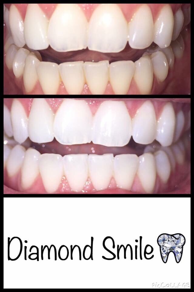 DIAMOND SMILE WHITENING - 45 Blumel Rd, Middletown, NY - Yelp