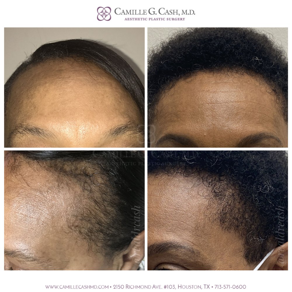 Before & 6 months after SmartGraft FUE transplantation. Full results ...