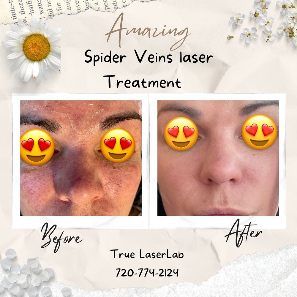 TRUE LASER LAB - 83 Photos - 1805 S Bellaire St, Denver, Colorado ...