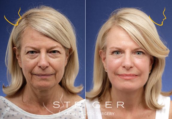 STEIGER FACIAL PLASTIC SURGERY: DR. JACOB D. STEIGER - Updated December ...