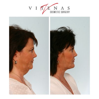 VITENAS COSMETIC SURGERY - Updated December 2025 - 177 Photos & 80 ...