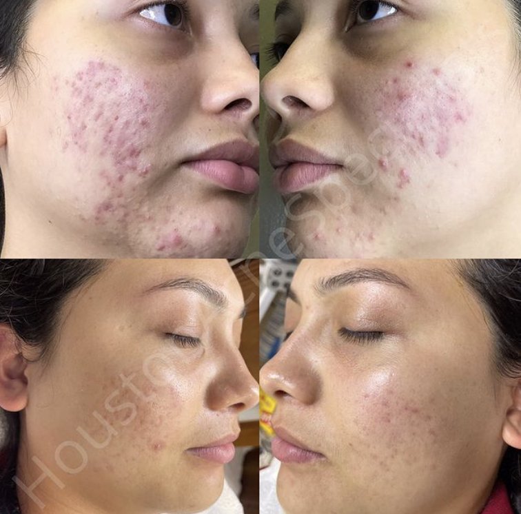 HOUSTON ACNE SPECIALISTS - Updated December 2025 - 77 Photos & 49 ...