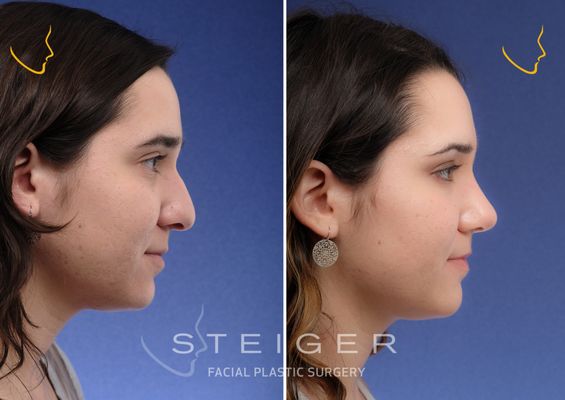 STEIGER FACIAL PLASTIC SURGERY: DR. JACOB D. STEIGER - Updated December ...