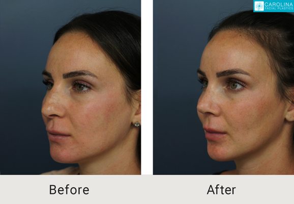 CAROLINA FACIAL PLASTICS - Updated June 2025 - 428 Photos & 36 Reviews ...