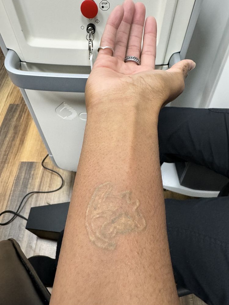 REMOVERY TATTOO REMOVAL & FADING - Updated May 2025 - 20 Photos & 14 ...