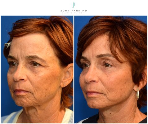 JOHN PARK MD PLASTIC SURGERY - Updated May 2026 - 126 Photos & 113 ...