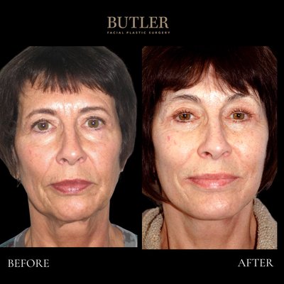 BUTLER FACIAL PLASTIC SURGERY - Updated October 2025 - 41 Photos - 2001 ...