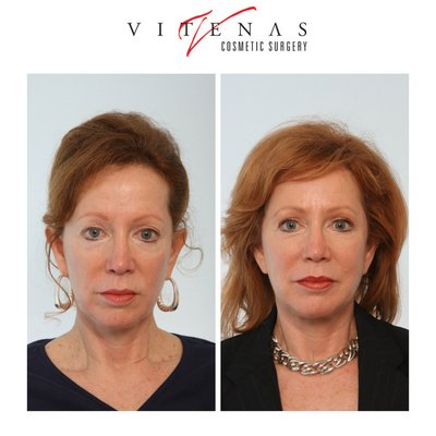 VITENAS COSMETIC SURGERY - Updated January 2026 - 177 Photos & 80 ...
