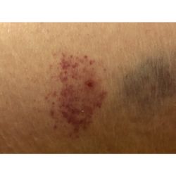 SCOTT C RACKETT, MD - MANHATTAN BEACH DERMATOLOGY - 31 Photos & 46 ...