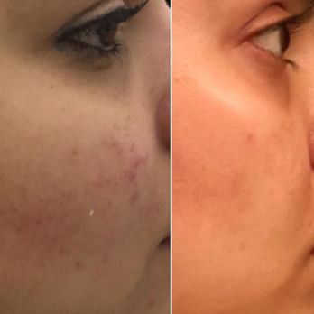 ACNE CLINIC NYC - Updated September 2025 - 99 Photos & 57 Reviews - 501 ...