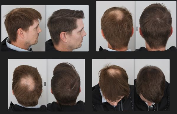 ADVANCED HAIR RESTORATION - 35 Photos & 24 Reviews - 11040 Main St ...