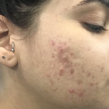 ACNE CLINIC NYC - Updated August 2025 - 99 Photos & 58 Reviews - 501 ...