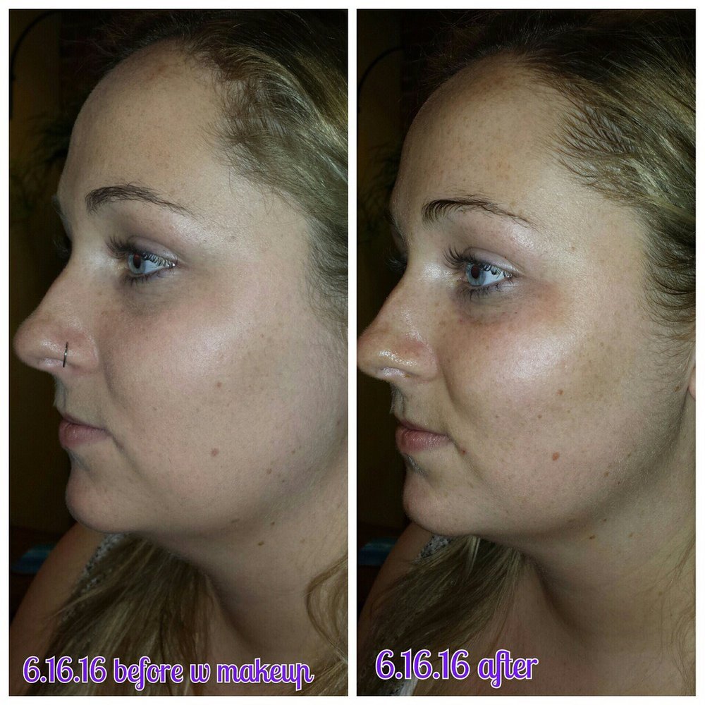 Acne Before And After Proactiv