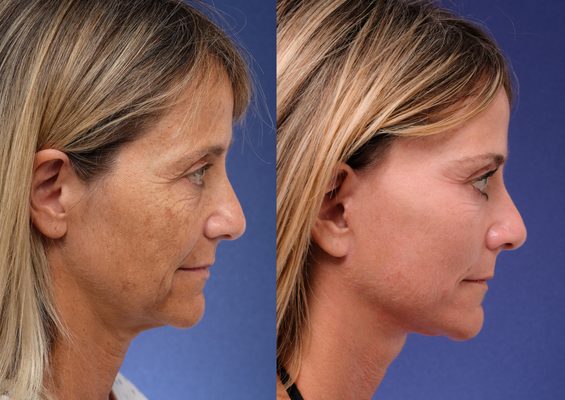 STEIGER FACIAL PLASTIC SURGERY: DR. JACOB D. STEIGER - Updated December ...