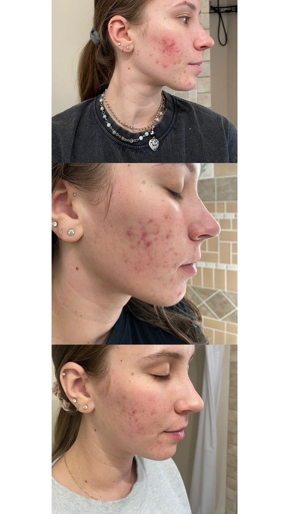 ACNE QUEEN SKIN CARE - Updated July 2025 - 15 Photos & 30 Reviews ...