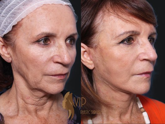 VIP PLASTIC SURGERY - Updated November 2025 - 119 Photos & 72 Reviews ...