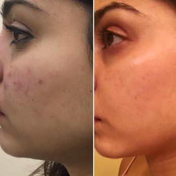 ACNE CLINIC NYC - Updated September 2025 - 99 Photos & 57 Reviews - 501 ...
