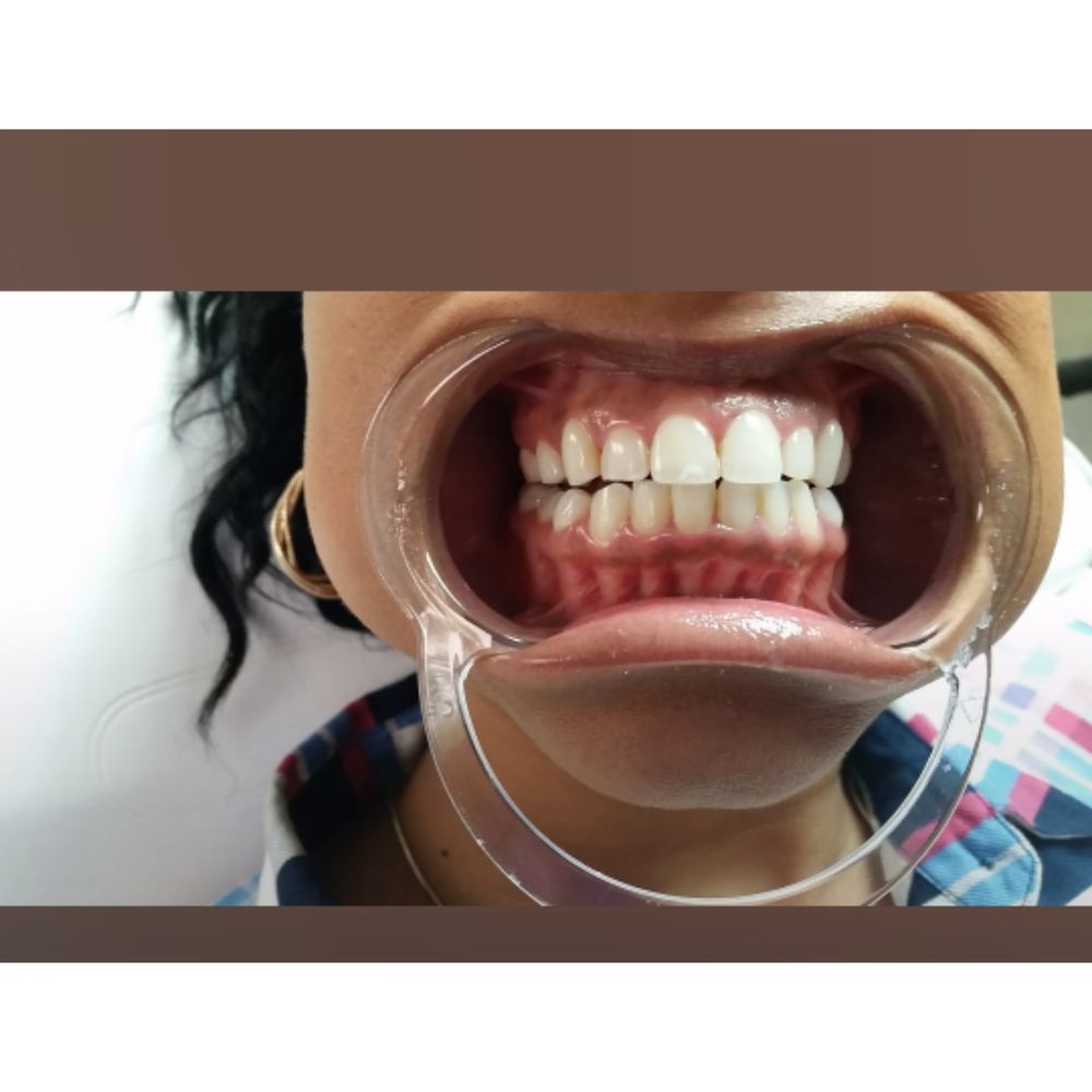 MALIBU TEETH WHITENING - Updated April 2026 - 32 Photos - 2103 E Parham ...