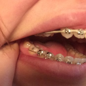 BRACETOWN ORTHODONTICS - Updated January 2026 - 17 Photos - 31-19 ...