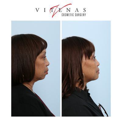 VITENAS COSMETIC SURGERY - Updated December 2025 - 177 Photos & 80 ...