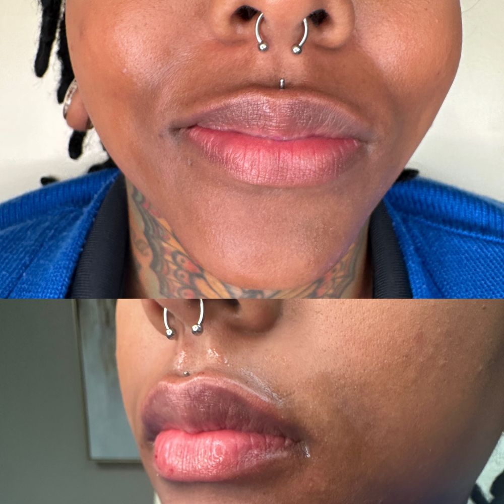KYUR AESTHETICS | NON-SURGICAL BBL | LIP FILLER - Updated January 2025 ...