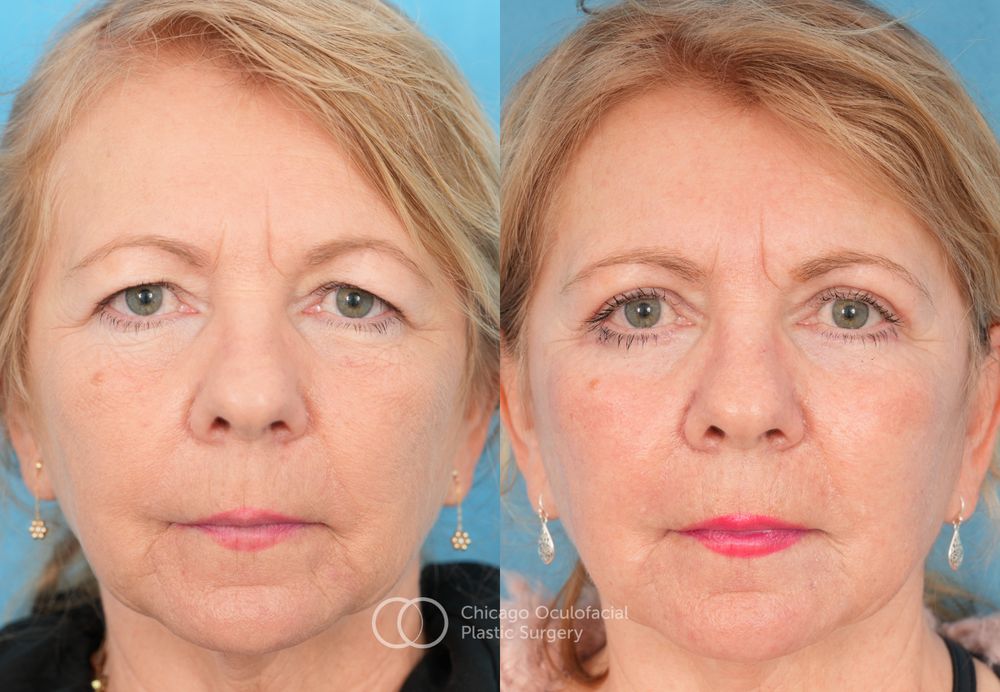 CHICAGO OCULOFACIAL PLASTIC SURGERY - Updated October 2025 - 20 Photos ...