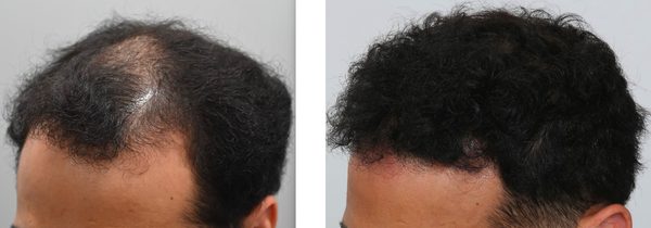ADVANCED HAIR RESTORATION - 28 Photos & 26 Reviews - 11040 Main St ...