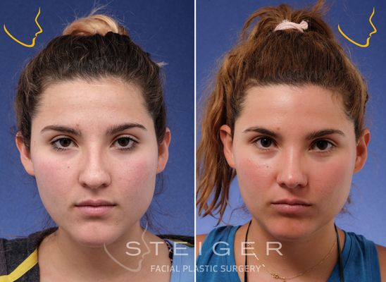 STEIGER FACIAL PLASTIC SURGERY: DR. JACOB D. STEIGER - Updated December ...