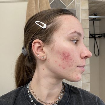 ACNE QUEEN SKIN CARE - Updated July 2024 - 12 Photos & 30 Reviews ...